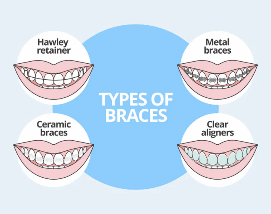 Braces and Aligners Treatment - Khivsara Dental Clinic
